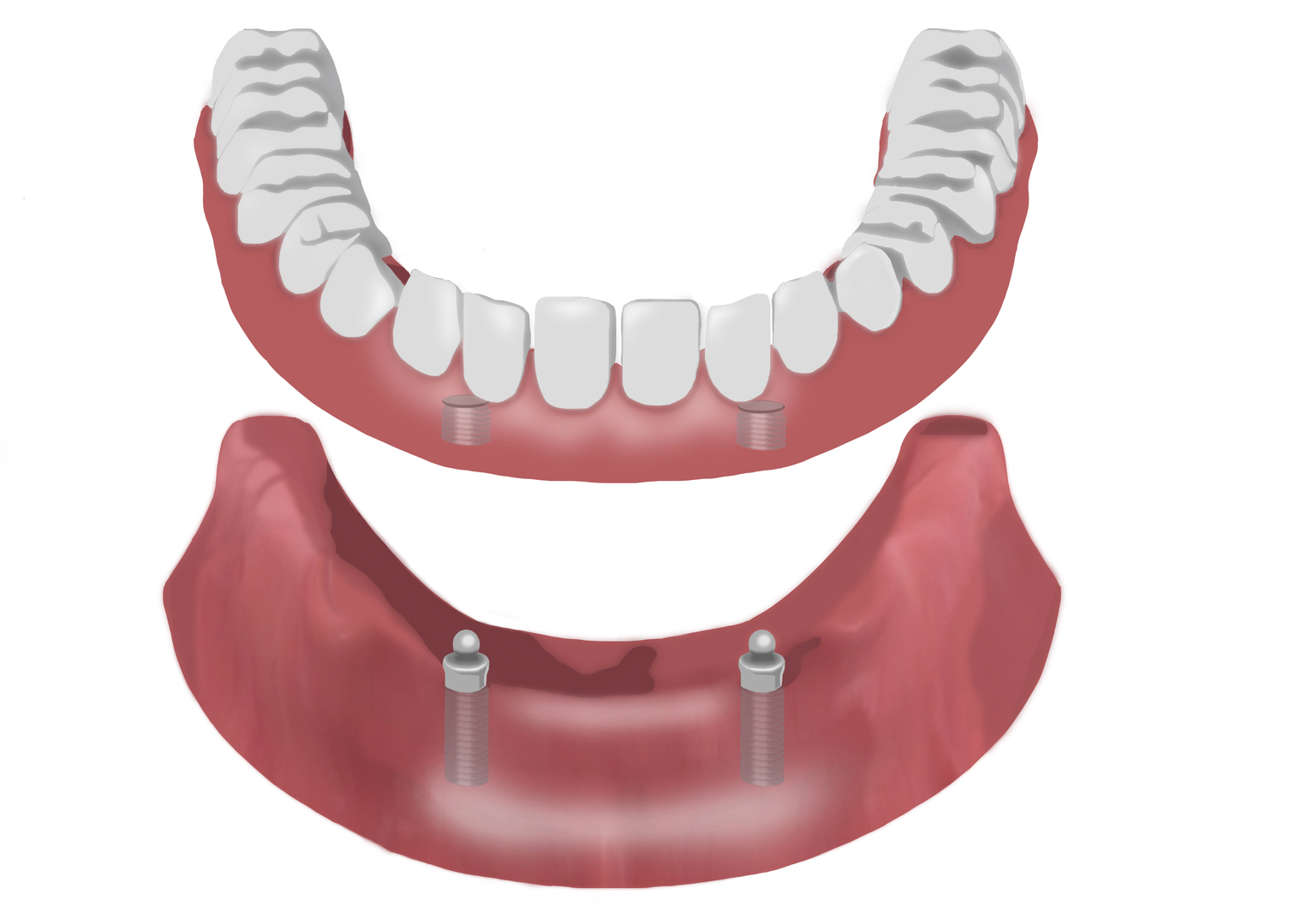 Sicherer Halt für Prothesen - do-zahn